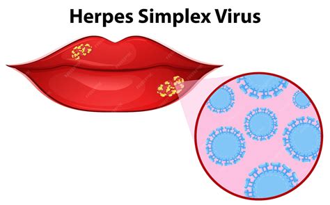 Premium Vector Diagram Showing Herpes Simplex Virus