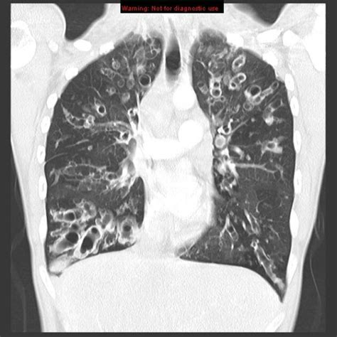 23 Hrct Of Cf Lungs Showing Multiple Severe Bronchiectasis Download Scientific Diagram
