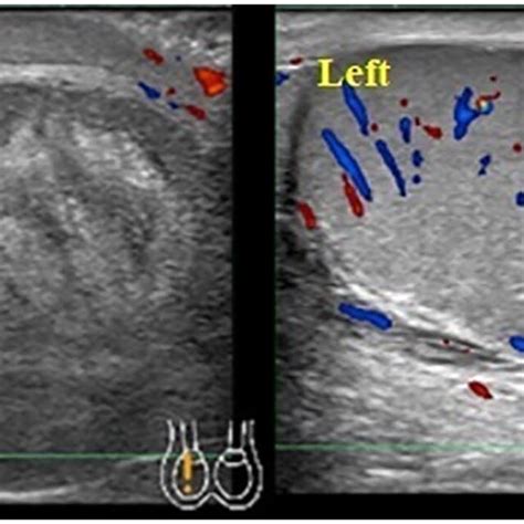 Comparison Of Final Diagnosis By Scrotal Exploration With Preoperative
