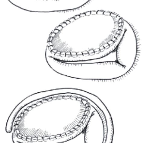The Anterior Leaflet Of Tv Is Enlarged By Using A Pericardial Patch Download Scientific Diagram