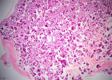 Ossifying Fibroma Pathology Outlines Fibro Osseous Pseudotumor Of The