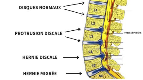 Protrusion Discale L5 S1 Traitement