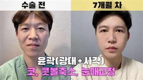 성형브이로그 효과 확실한 남자성형후기 ️ 👉윤곽광대 사각턱 코성형 절개눈매교정👈 눈매교정후기코성형후기성형후기윤곽수술후기남자성형브이로그코성형전후성형