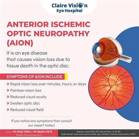 Anteriorischemicopticneuropathy Aion Opticneuropathy Clairevision