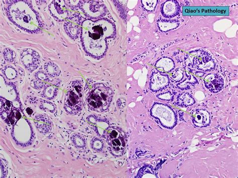 Qiaos Pathology Microcalcifications In Benign Breast Tissue A Photo On Flickriver