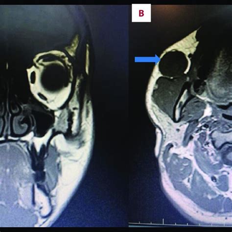 Mri Shows A Cystic Lesion Anterior To The Right Masseter Muscle