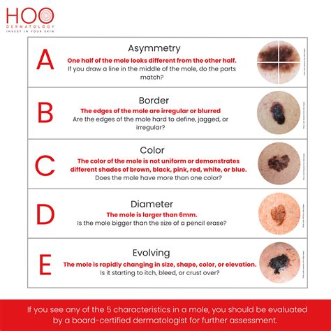 Monitor Your Moles With Abcde Hoo Dermatology