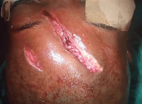 Photograph Showing A 10 Cm Long Full Thickness Scalp Laceration With