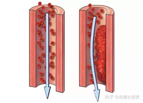 关于下肢动脉硬化闭塞症的那些事 知乎