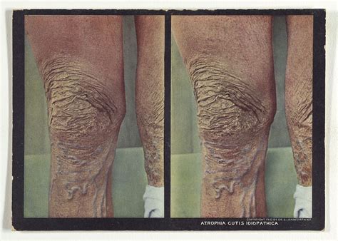 Atrophia Cutis Idiopathica Dr Selden Free Photo Rawpixel