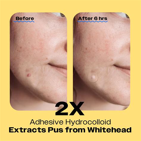 Mua Avarelle Hydrocolloid Pimple Patch 40 Patches Made In Korea