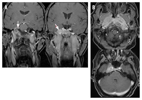 Trigeminal Nerve Mri Sagittal