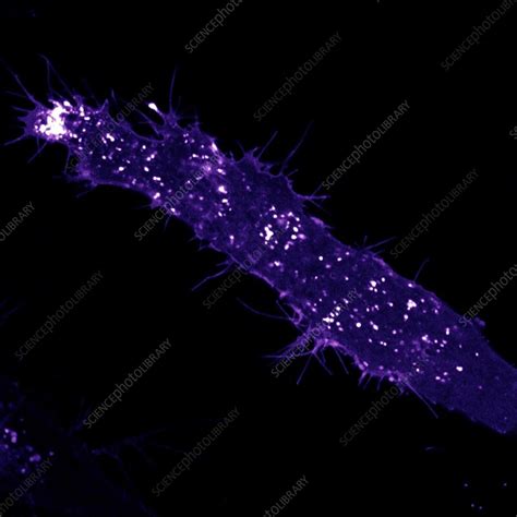 Ewing Sarcoma Cancer Cell Light Microscopy Stock Video Clip K014 8396 Science Photo Library