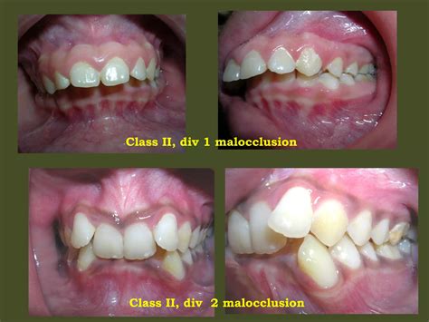 Class Ii Malocclusion Ppt