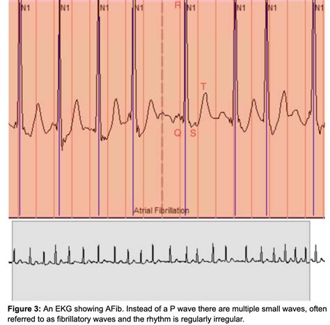 What Are PACs Eureka