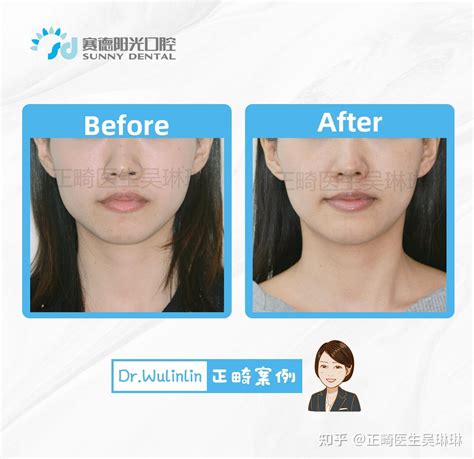 拨乱反正笑出美好牙齿不齐矫正案例分享 知乎