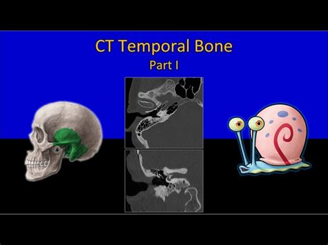 Temporal Bone