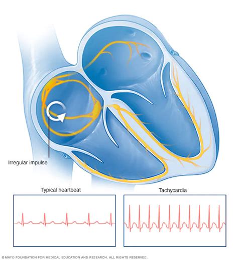 Tachycardia Disease Reference Guide Drugs Com
