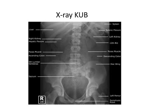 Solution Abdominal X Ray Showing Scout View Prone View Left Lateral Decubitus Calcification