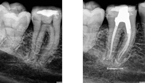 Endodontic Access For Conservationists A How To Guide The Endospot