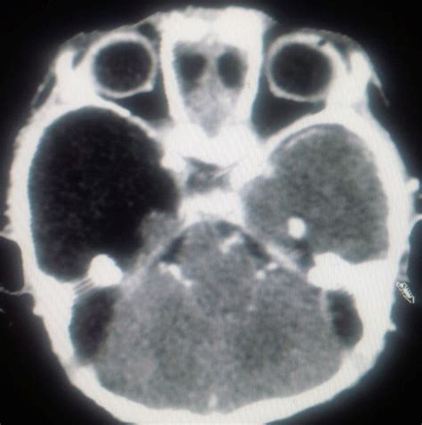 Axial Ct Image Showing Preserved Cerebellum Brain Stem Structures And