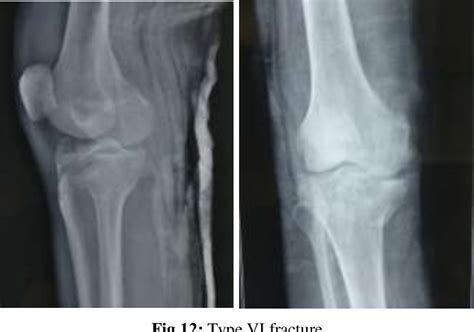 Figure 1 From Functional Outcome Of Tibial Plateau Fractures Schatzker Type V And Vi Treated