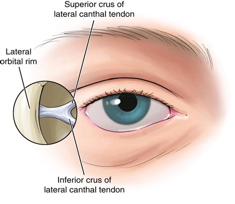 Lateral Canthotomy Clinical Tree