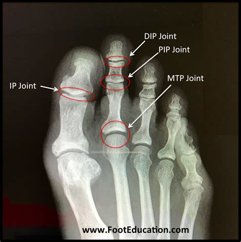 Middle And Distal Phalanges