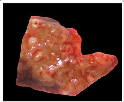 Grosse Liver Biopsy Demonstrating Multiple Microabscesses Download