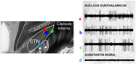 Subthalamic Nucleus Microelectrode Recording Showing Different Download Scientific Diagram