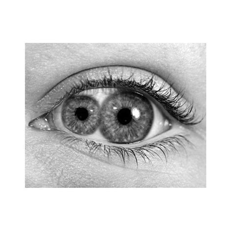 Pupula Duplex An Extremely Rare Condition Where There Are Two Pupils