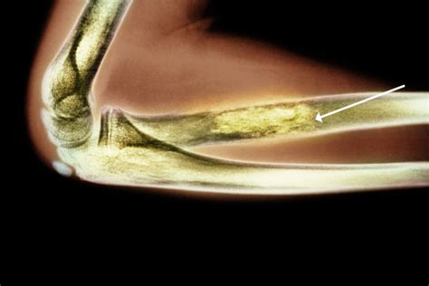 Ewing Sarcoma Bone Cancer Cancer Therapy Advisor