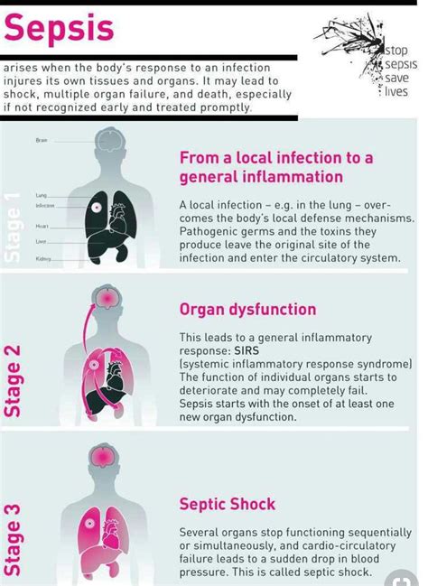 Your Stepbystep Guide To Sepsis Plus A Free Cheat Sheet