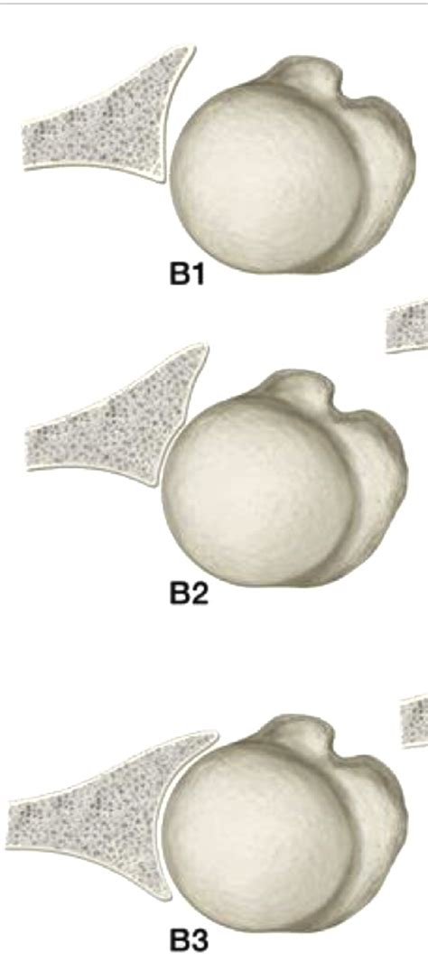 Shoulder Arthritis Joint Replacement Shoulder Arthritis With Type B