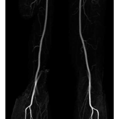 Magnetic Resonance Angiogram Of The Peripheral Arteries In Maximum