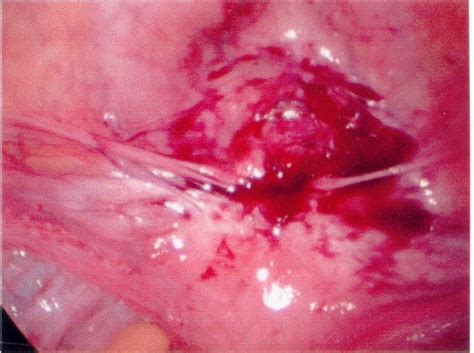 Mirena Removal Graphic Pictures At Mirena Skyla IUD Forum With Image Embedded Topic 860247
