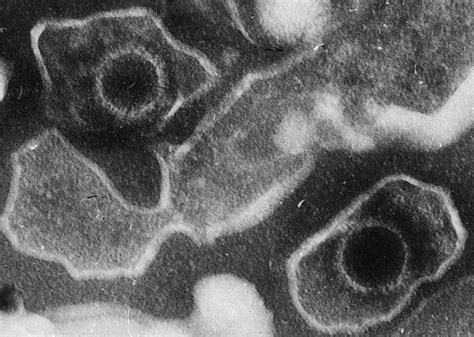 Epstein Barr Virus Linked To Seven Serious Diseases