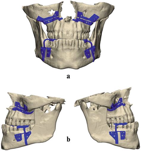 2 Computer Aided Design Models Of The Patient Specific Guides Psgs