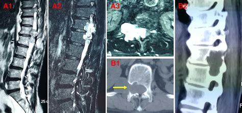 Preoperative Mri And Ct Showed Thoracic Dumbbell Shaped Tumor Of A Download Scientific Diagram