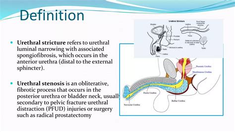 Urethroplasty Principles And Practicess Pptx