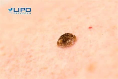 Seborrheic Keratosis Treatment Suffolk Fast Results