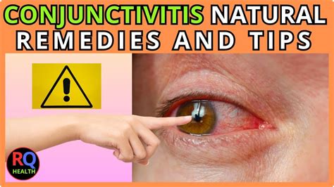 049 Conjunctivitis Causes Symptoms And Natural Remedies To Cure It Youtube
