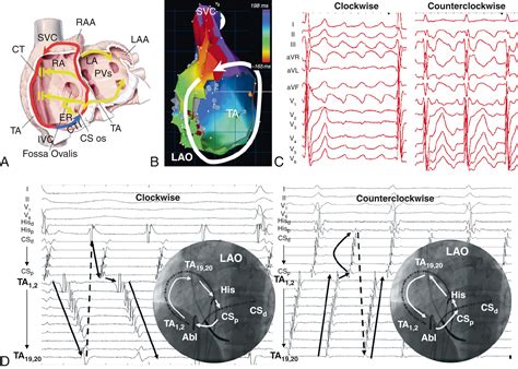 Typical And Atypical Atrial Flutter Mapping And Ablation Clinical Tree