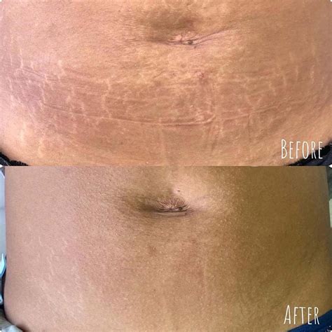 Microneedling Before And After Results 40 Examples Gallery
