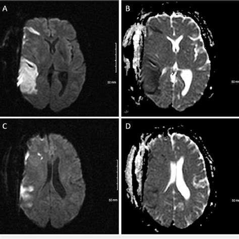 Brain Mri Of The Patient 36 Hours After Stroke Symptoms Axial
