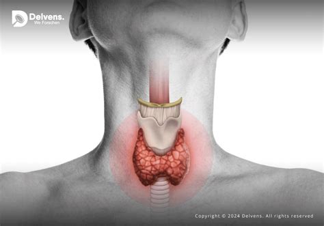 Pendred Syndrome Ps Market Research Report Achieving Usd 3 83 Billion In 2030 At A Cagr Of 4 5
