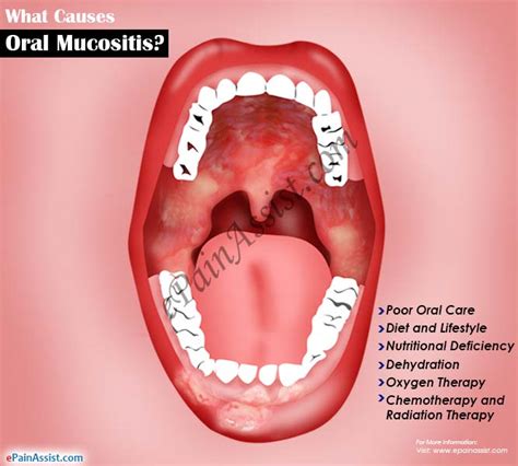 Mucositis Pathophysiology