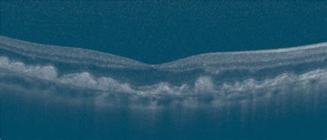 Dry Amd And Geographic Atrophy 2023