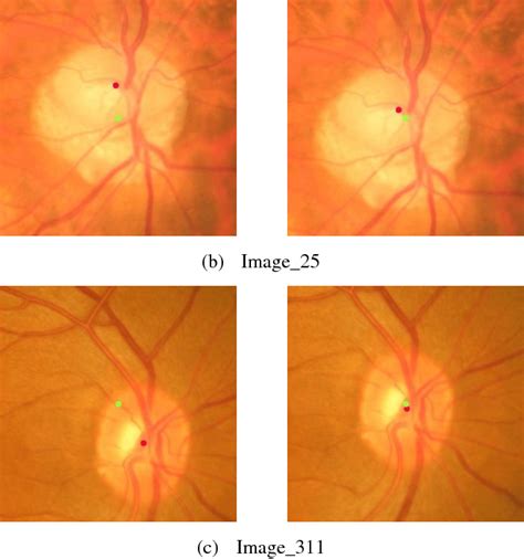 Figure 2 From Automatic Localization Of Optic Disc Using Modified U Net Semantic Scholar