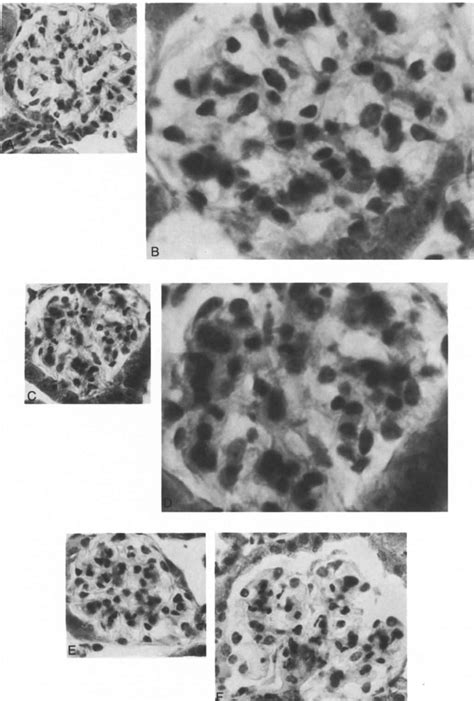 effect of a717 antibody to glycated albumin on glomerular histology in